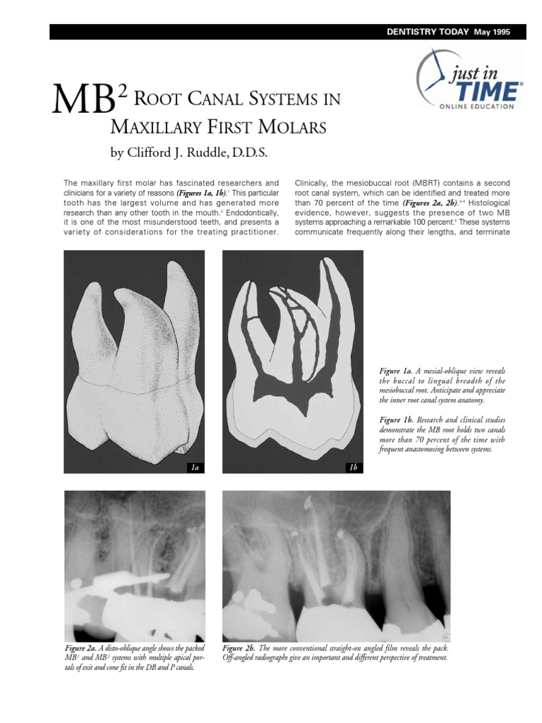 MB2 Canal Systems in Maxillary First Mollars | PDF