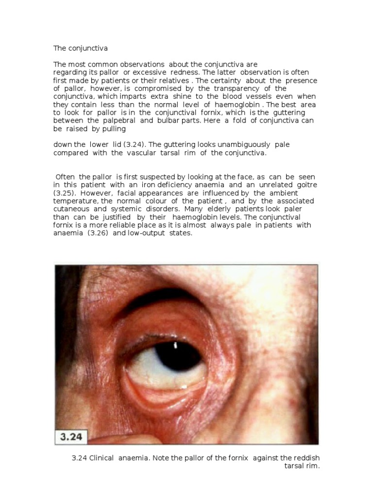 Pallor Conjunctiva