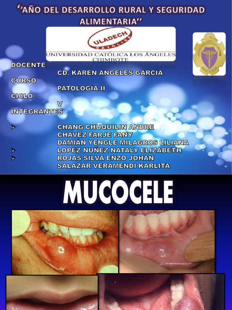 Mucocele Expo[1] | Anatomía | Medicina