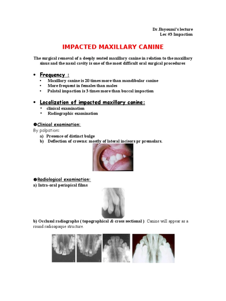 Impacted Maxillary Canine | PDF | Dentistry | Primate Anatomy