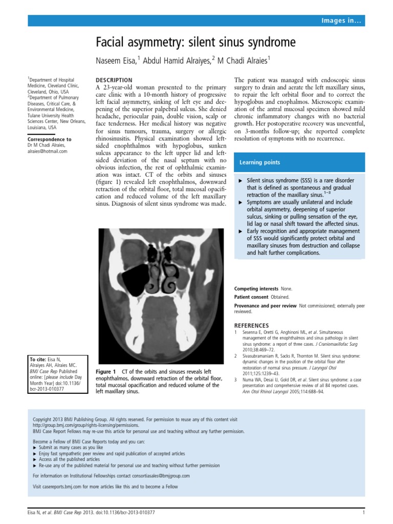 Diagnosis And Management Of Silent Sinus Syndrome S – IDOCTJ