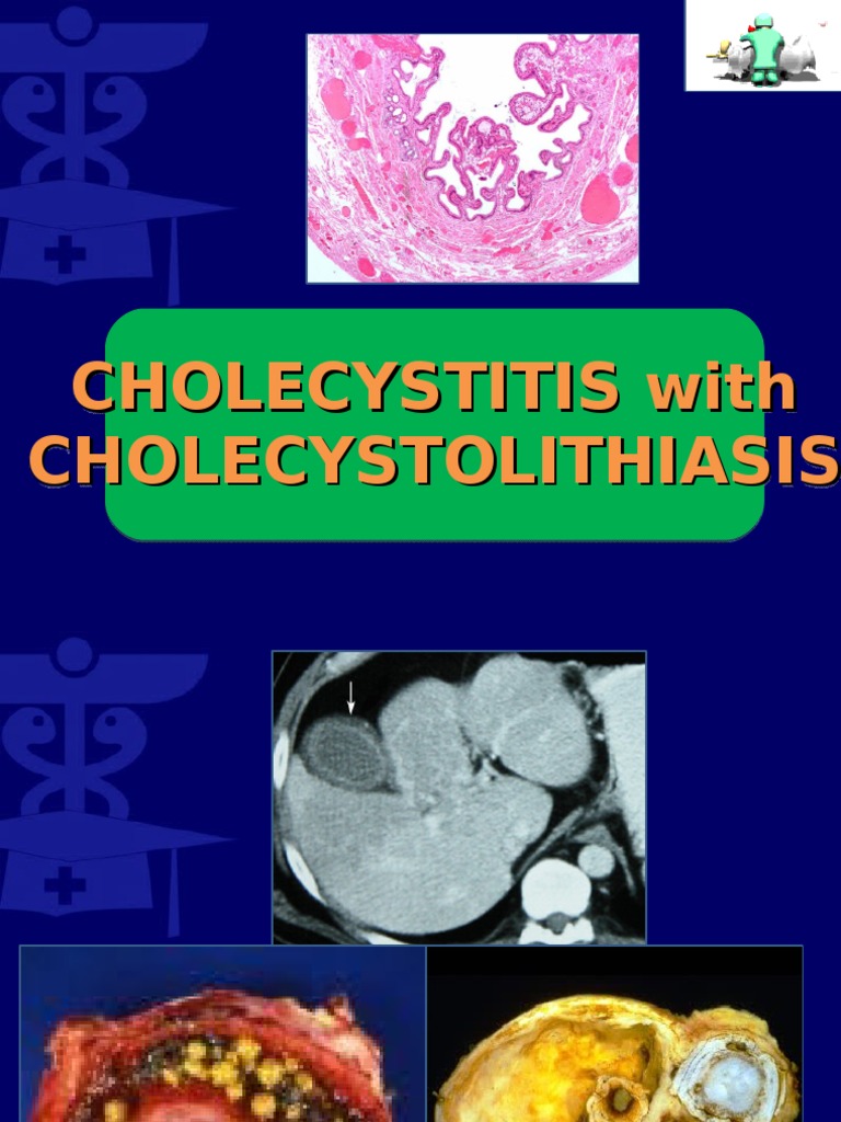 Cholecystitis and Cholecystolithiasis Overview | PDF | Gallbladder | Bile
