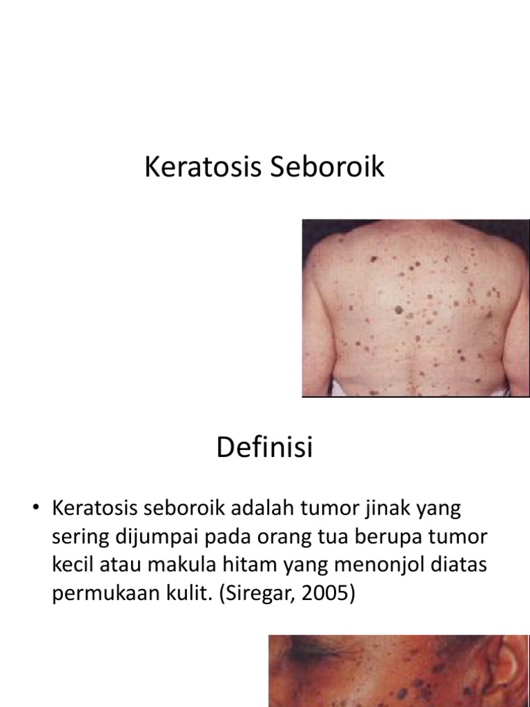 Keratosis Seboroik | PDF | Kesehatan Holistik