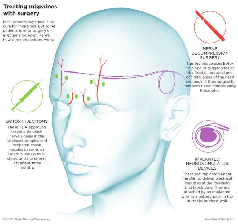 Illustration: Treating Migraines With Surgery | PDF | Migraine ...