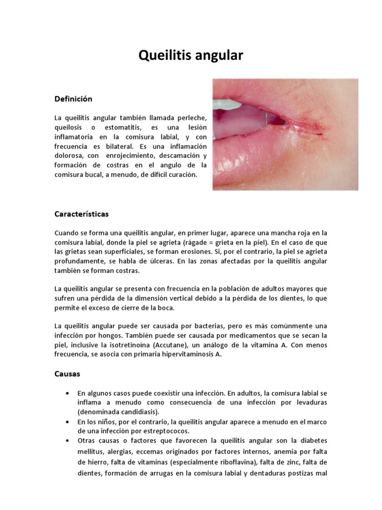 Queilitis Angular | PDF | Rtt | Epidemiología