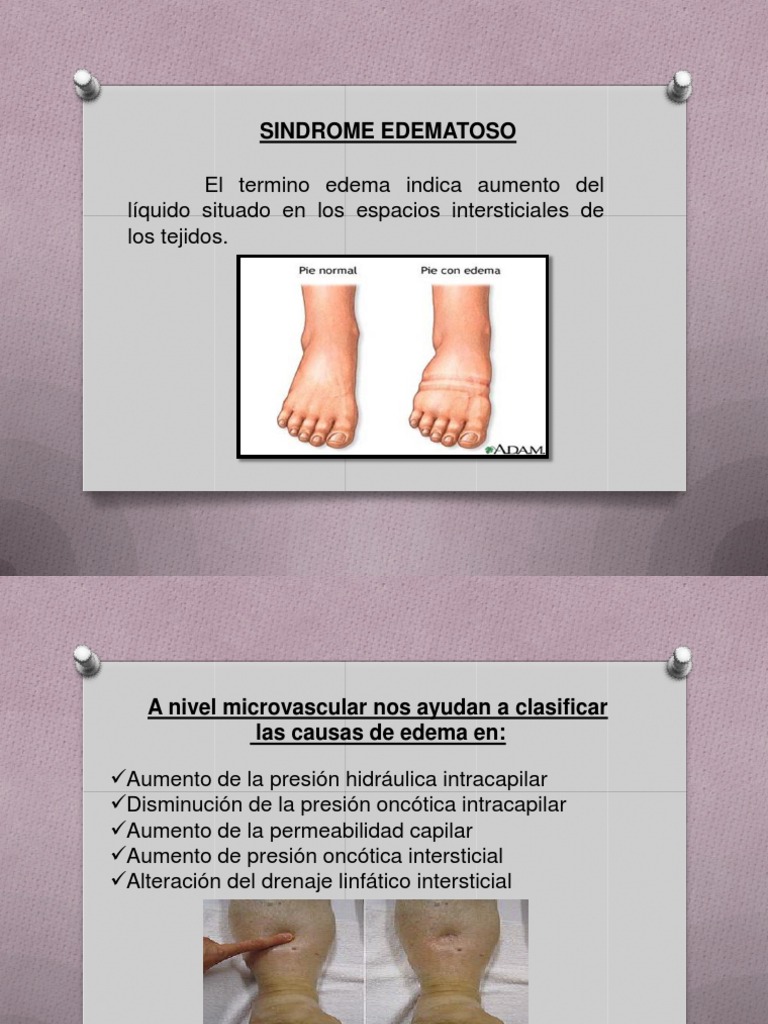 Diapositivas de Sindrome Edematoso | Edema | Enfermedades y trastornos ...