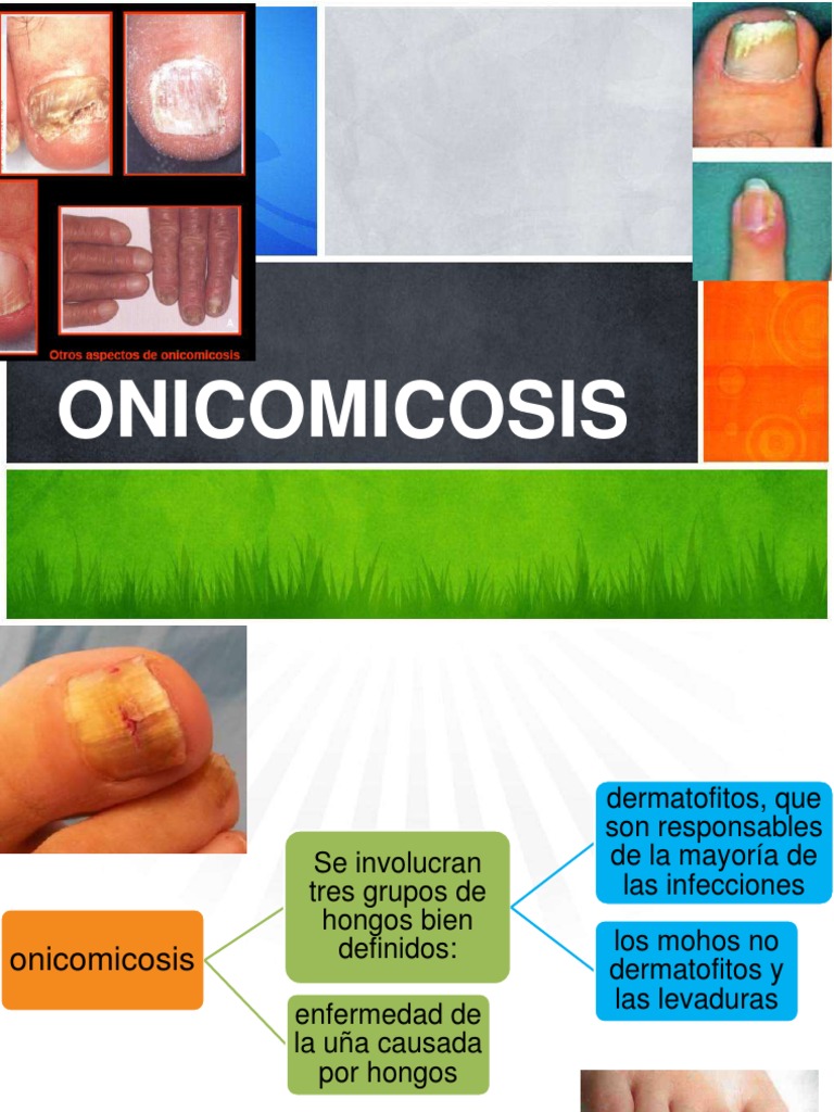 Onicomicosis: Causas y Tratamientos | PDF | Clavo (anatomía) | Inmunología