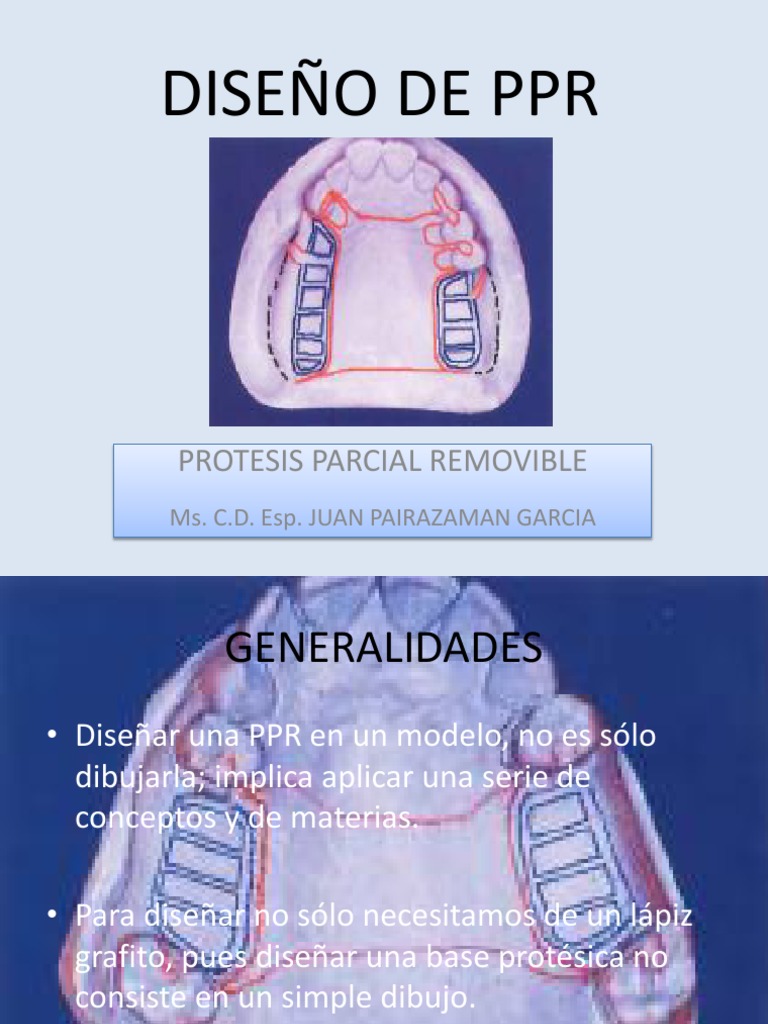 Diseño PPR 1 | Dentadura postiza | Boca