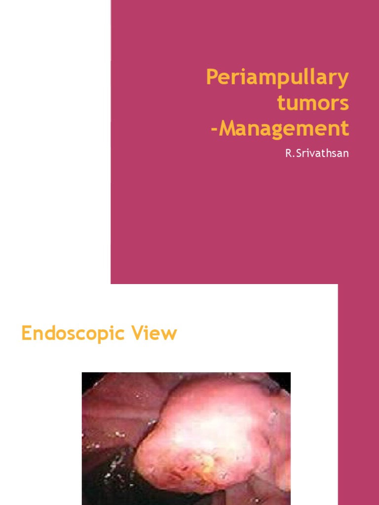 Periampullary Carcinoma | PDF | Pancreatic Cancer | Pancreas