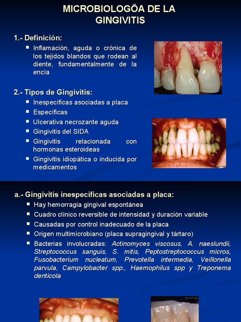 Microbiología de la Gingivitis | Inmunología | Especialidades médicas