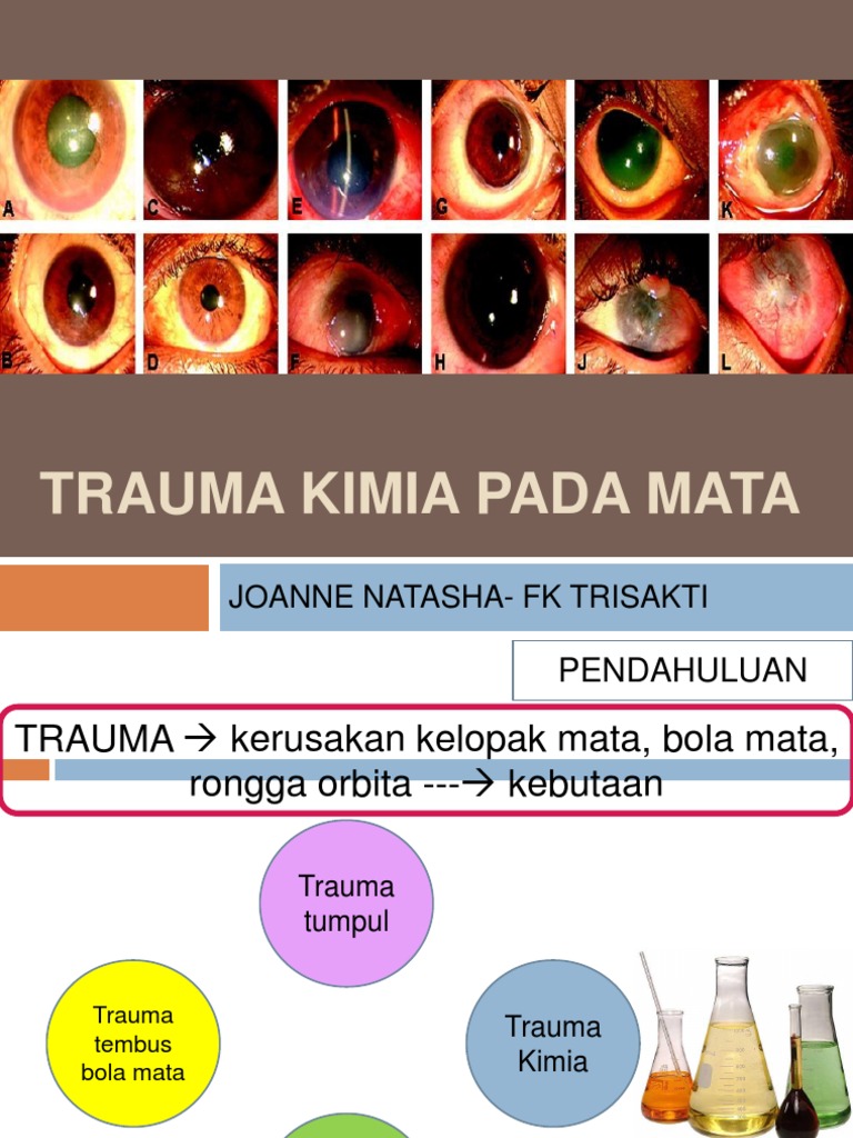 Trauma Kimia Pada Mata | PDF