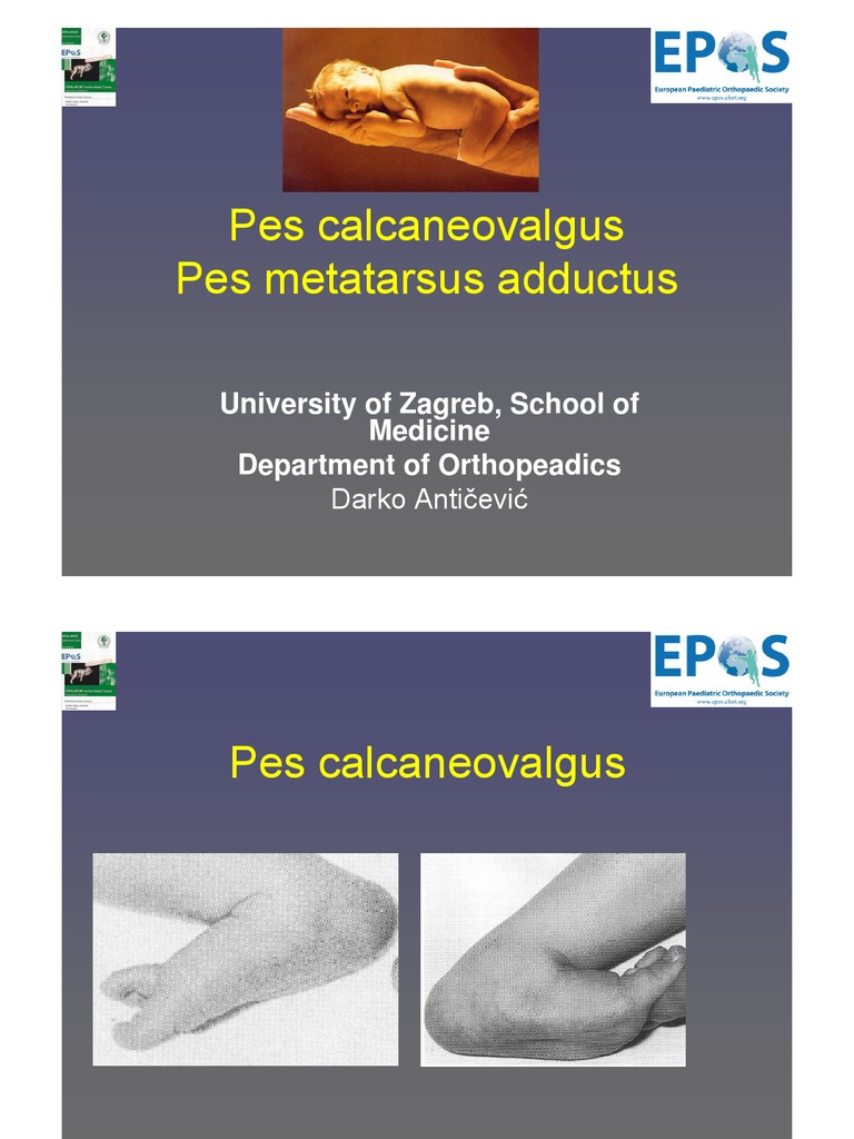 6. Pes Calcaneovalgus Anticevic 18.05.2011 | Foot | Diseases And Disorders