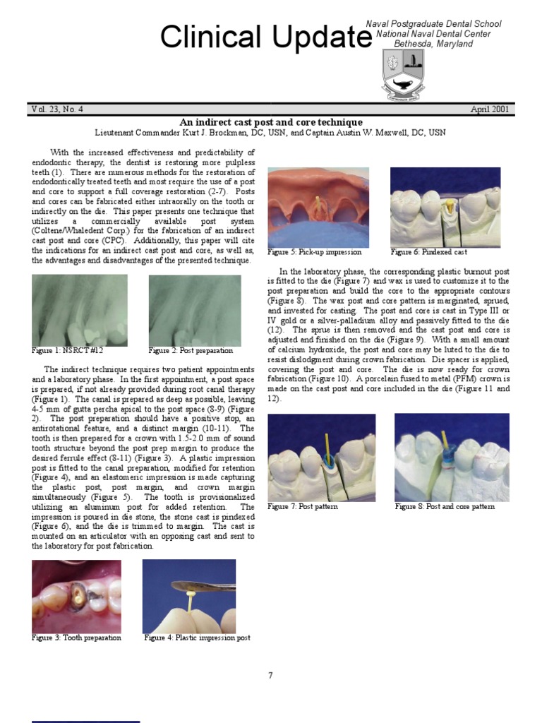 01 - 004 An Indirect Cast Post and Core Technique | PDF | Health Care ...