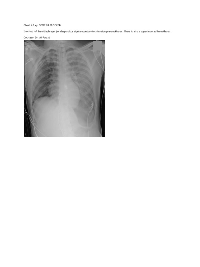 Deep Sulcus Sign | PDF