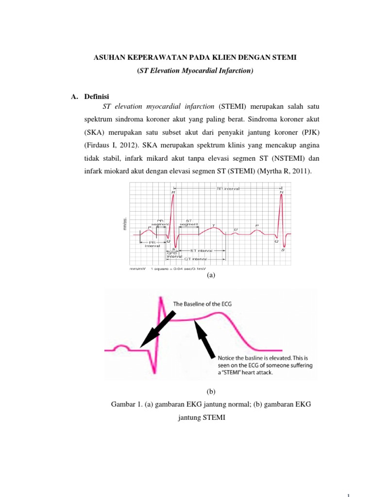 LP Stemi | PDF
