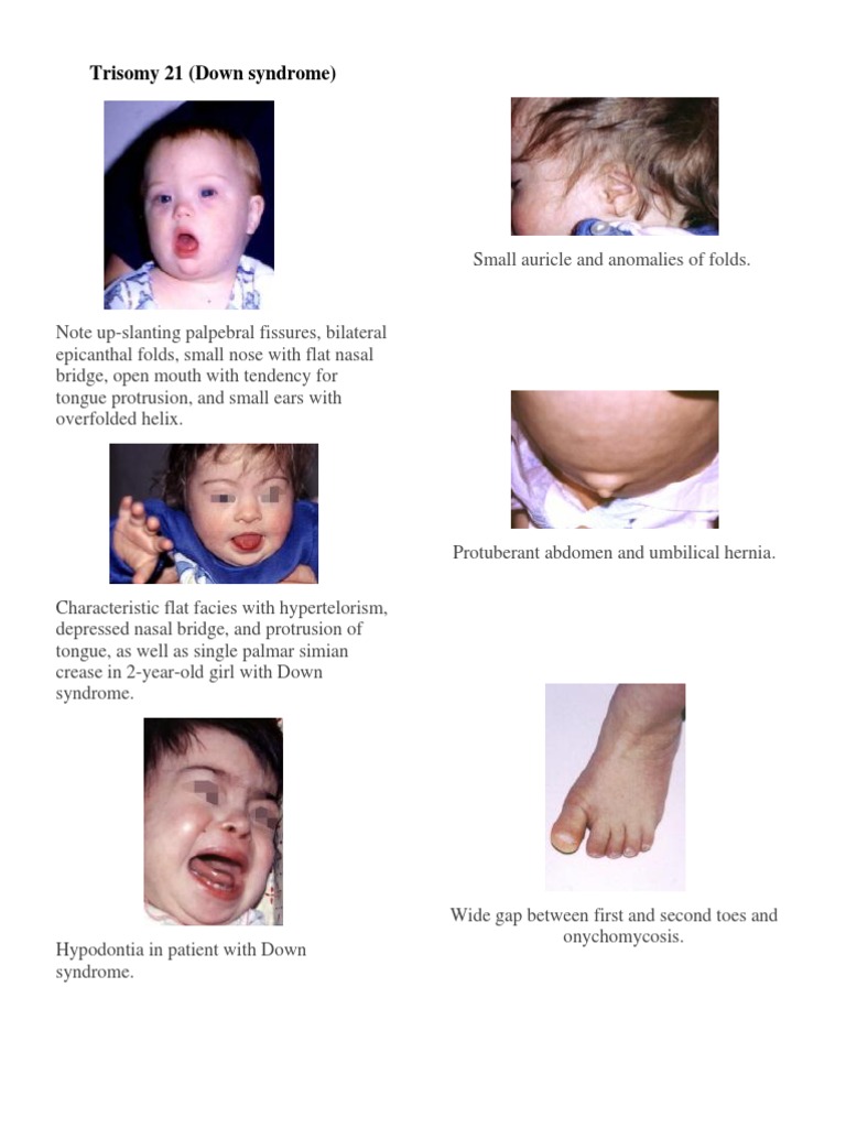 Trisomy 21.docx | Autism | Down Syndrome | Free 30-day Trial | Scribd