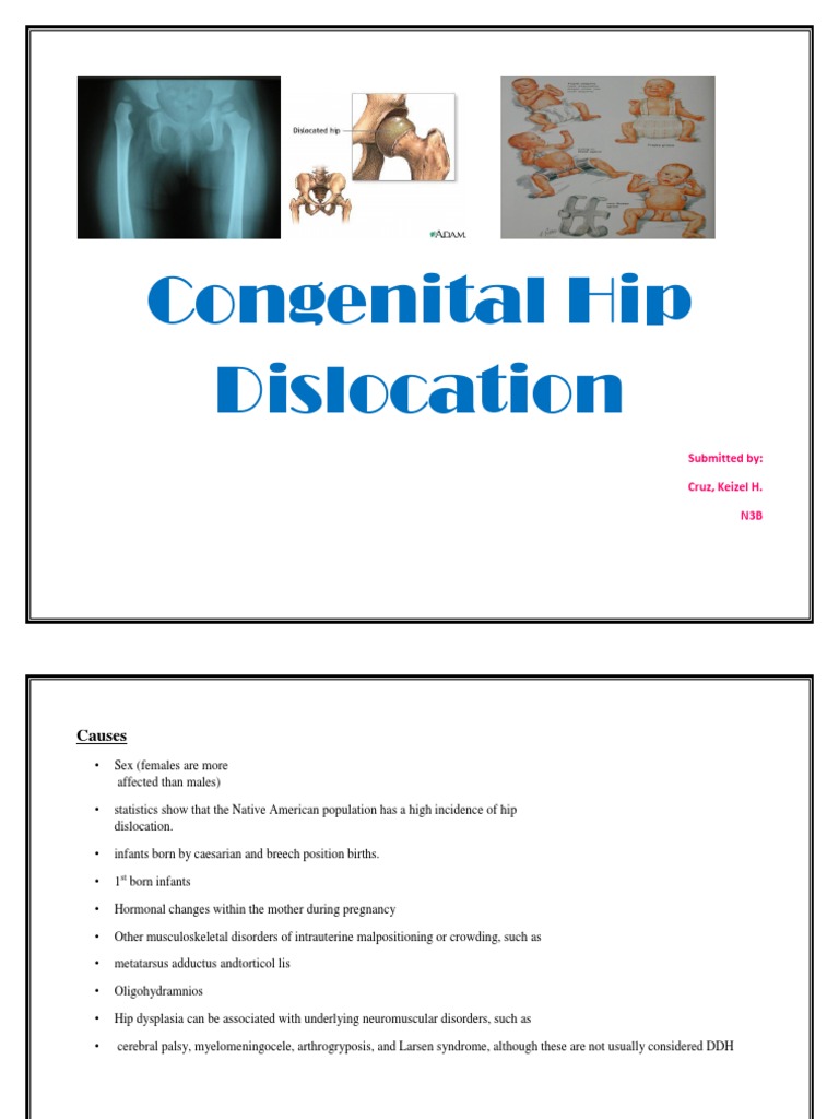 Congenital Hip Dislocation | PDF | Hip | Musculoskeletal System
