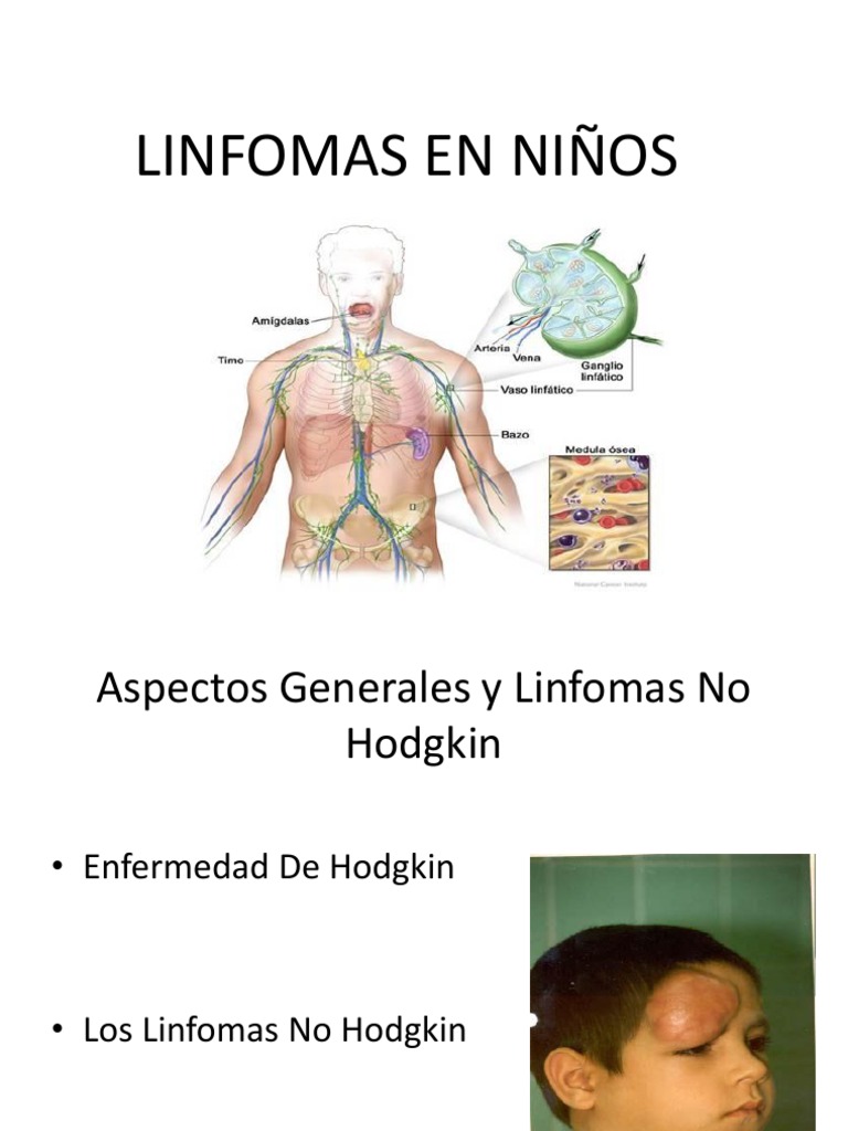 Linfomas en Niños | PDF | Linfoma | Linfocitos