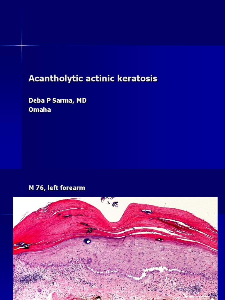 Acantholytic Actinic Keratosis, M 76, Left Forearm