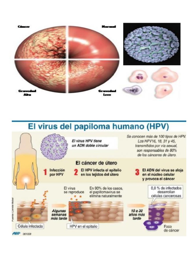 Infección Genital Por VPH | PDF