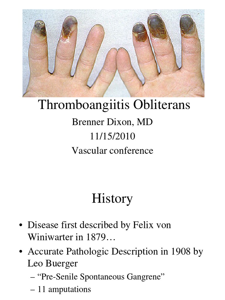 Thromboangiitis Obliterans | Angiology | Vascular Diseases