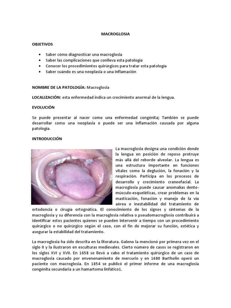 MACROGLOSIA | Ortodoncia | Cáncer
