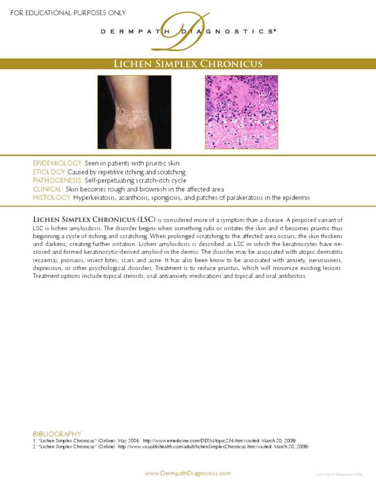 Understanding Lichen Simplex Chronicus | PDF