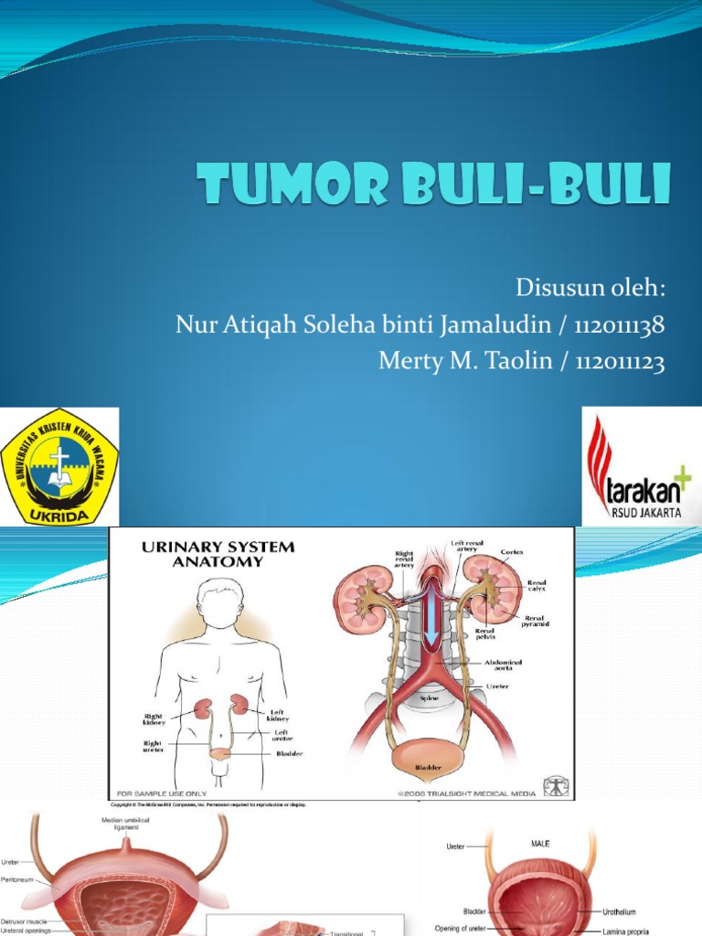PP Tumor Buli | PDF