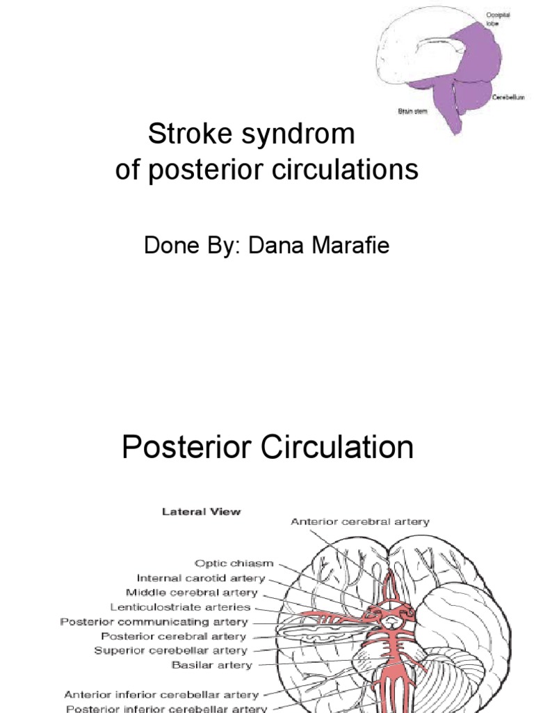 16 Stroke Syndromes | Central Nervous System | Neuroanatomy