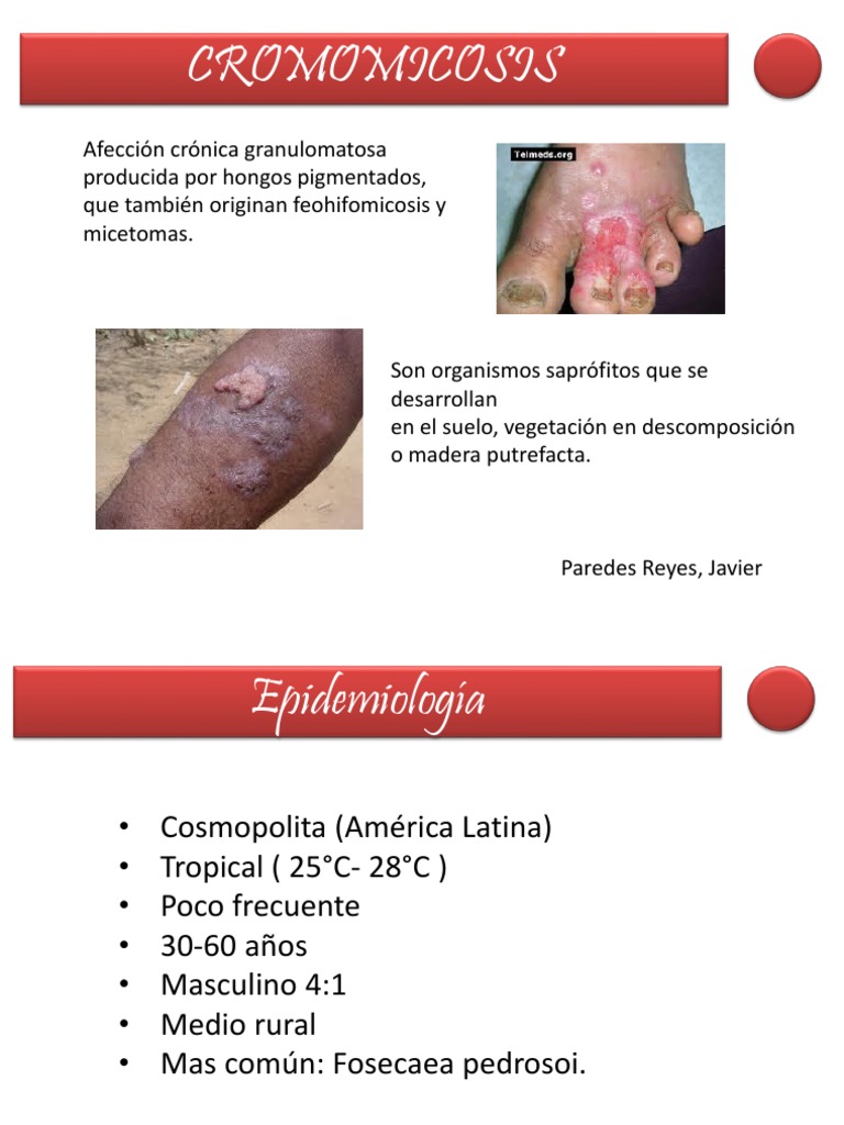 cromomicosis | Medical Specialties | Immunology