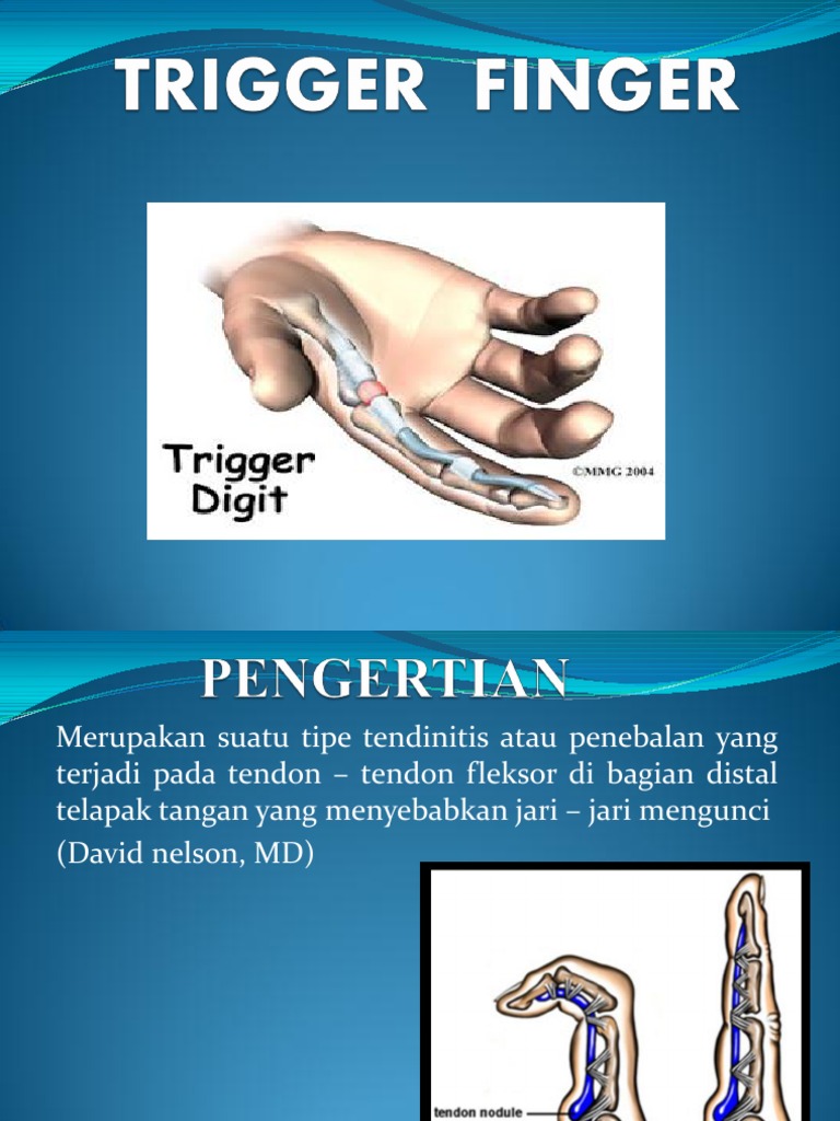 Trigger Finger | PDF