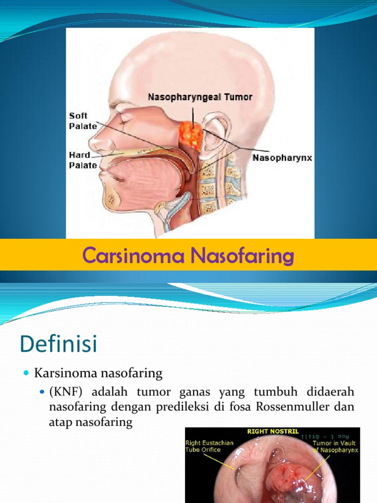 CA Nasofaring | PDF | Kesehatan Holistik | Sains & Matematika