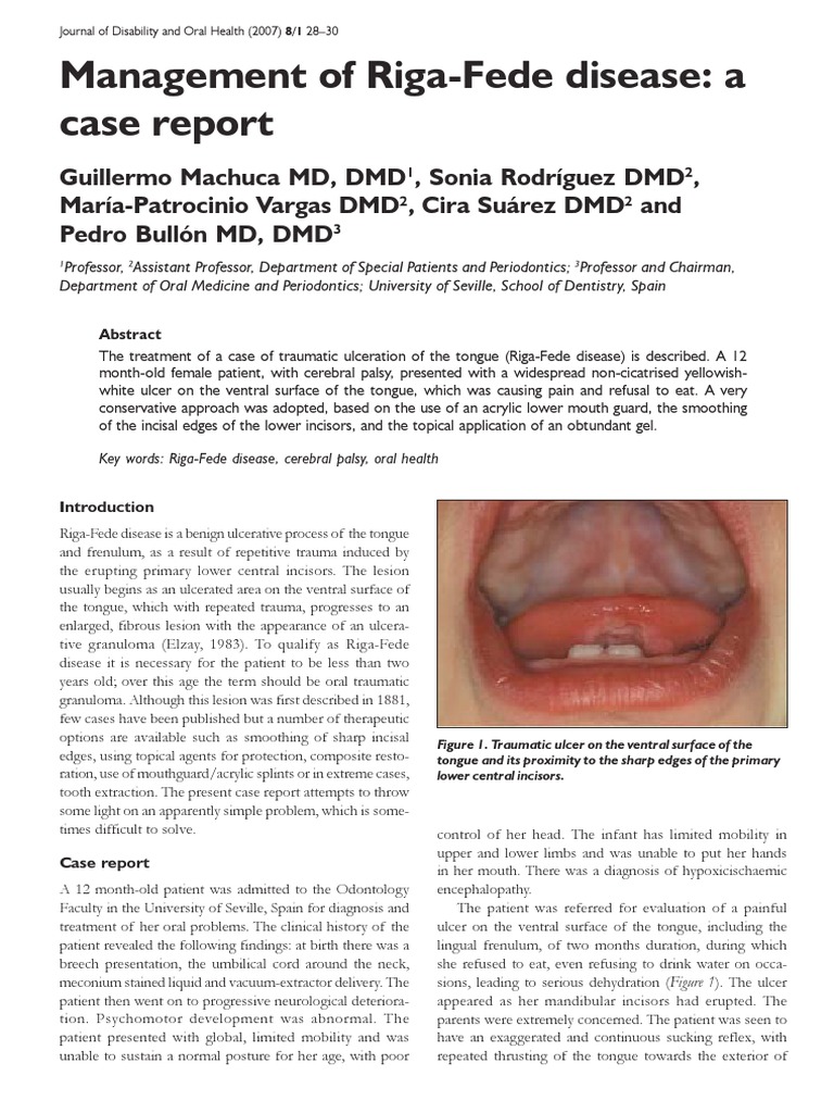 Management of Riga Fede Disease a Case Report | Dentistry | Medical ...