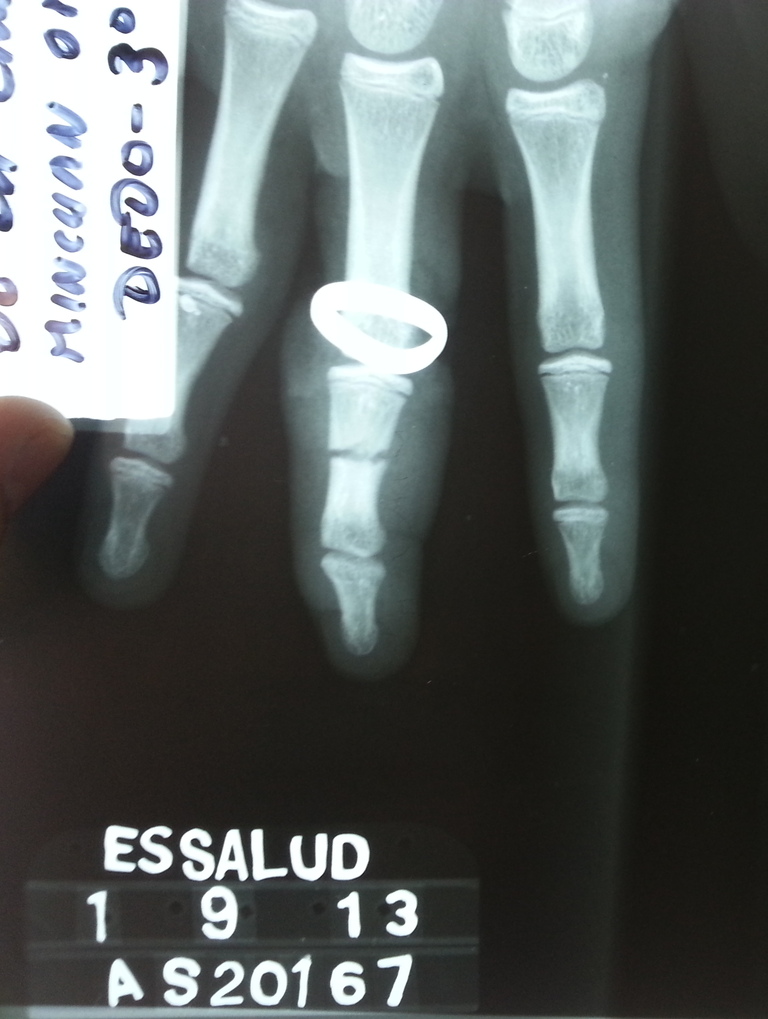 Traumatismo contuso cortante en dedo medio derecho con fractura de ...