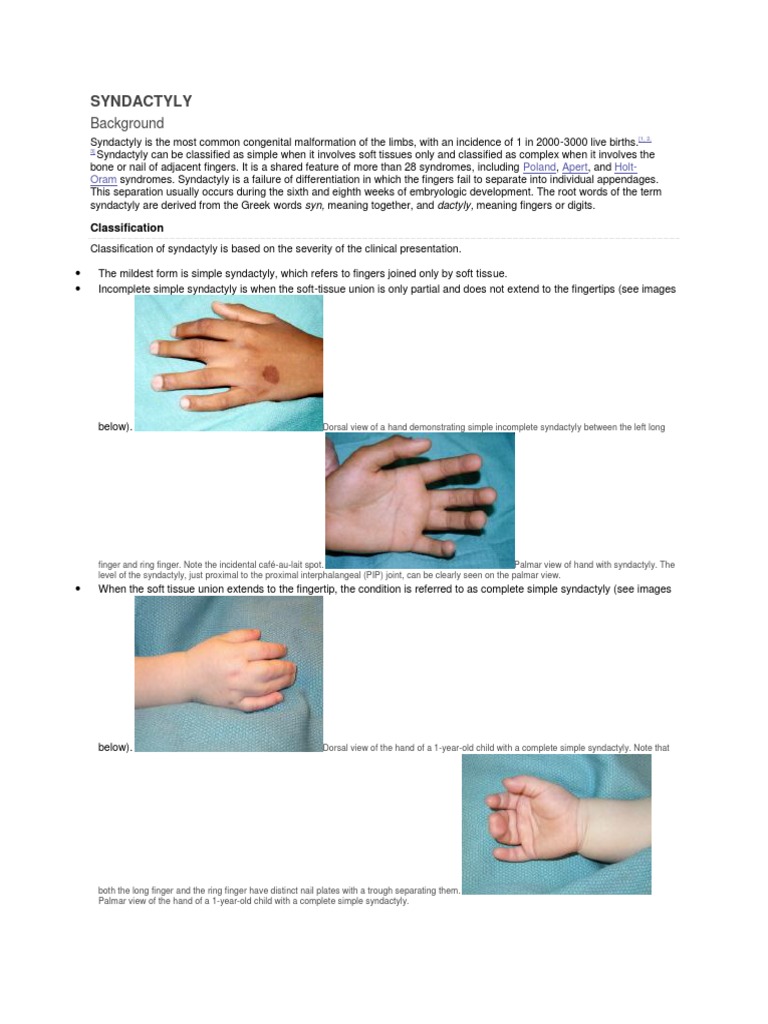 Classification and Associated Syndromes of Syndactyly: A Comprehensive ...