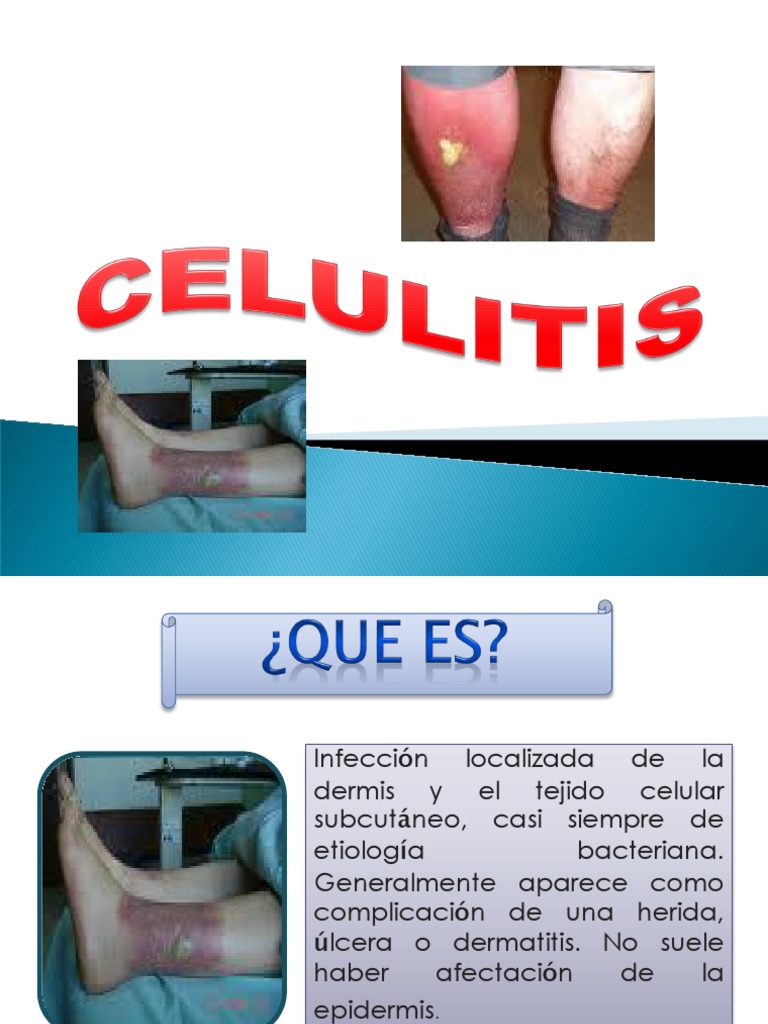 celulitis.ppt | Piel | Medicina