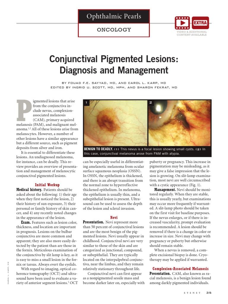 Conjunctival Pigmented Lesions | PDF | Melanoma | Cancer