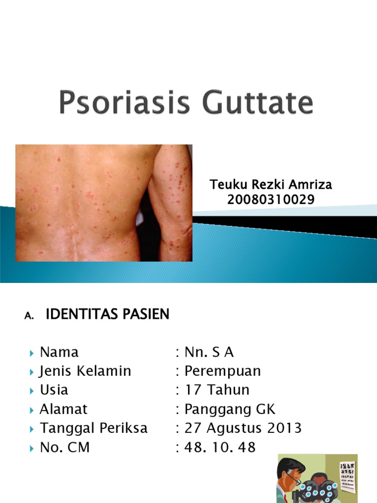 Psoriasis Gutata | PDF