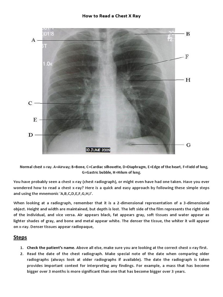How to Read a Chest X-Ray Guide | PDF | Lung | Anatomy