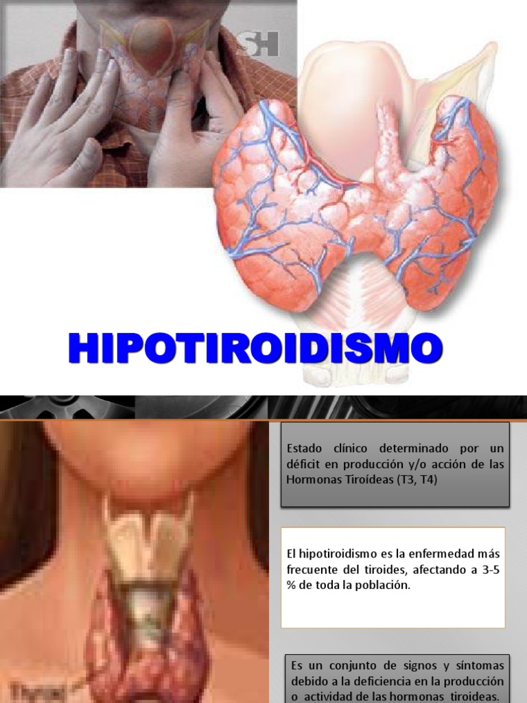 Hipotiroidismo Primario: Un Caso Clínico Ejemplar | PDF | Hipotiroidismo | Tiroides