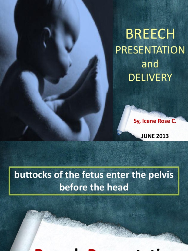 Breech Delivery | PDF | Caesarean Section | Childbirth