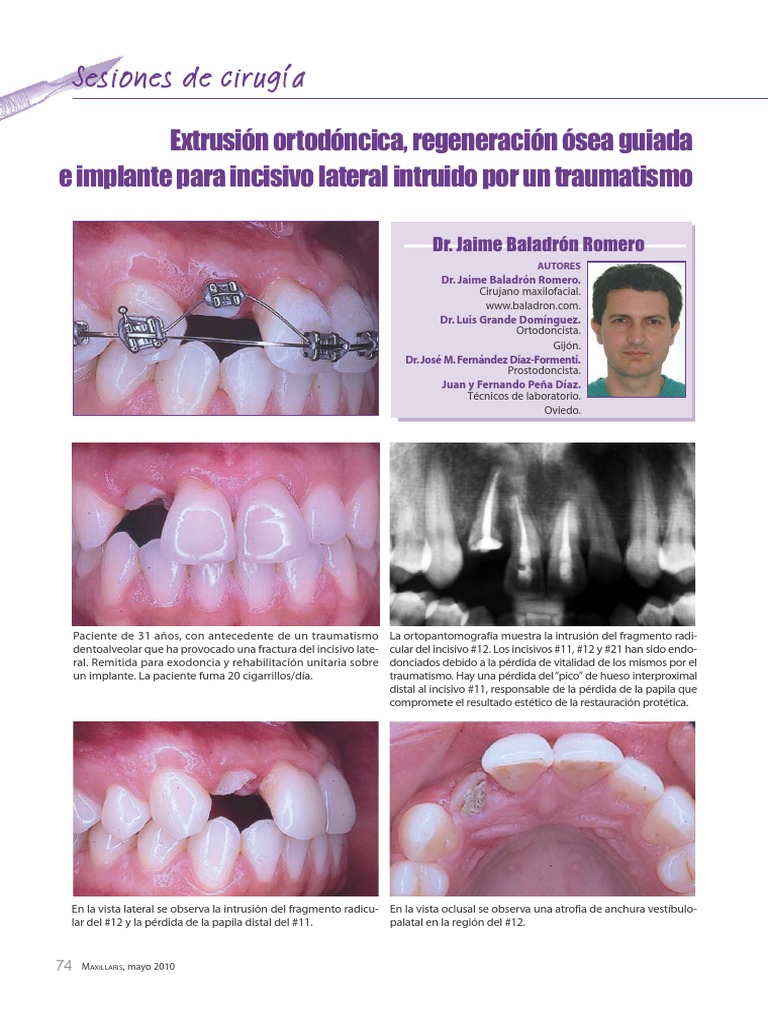 04 - Extrusión Ortodóncica, Regeneración Ósea Guiada e Implante | PDF ...