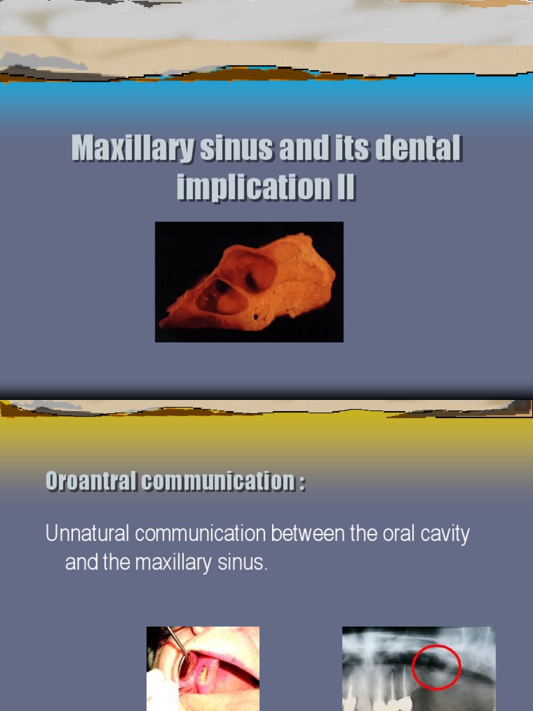 Maxillary Sinus and Its Dental Implication II | PDF | Surgery | Human ...