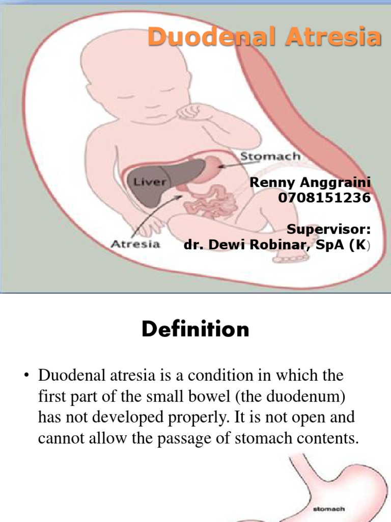 Duodenal Atresia Pdf Congenital Disorder Gastrointestinal Tract