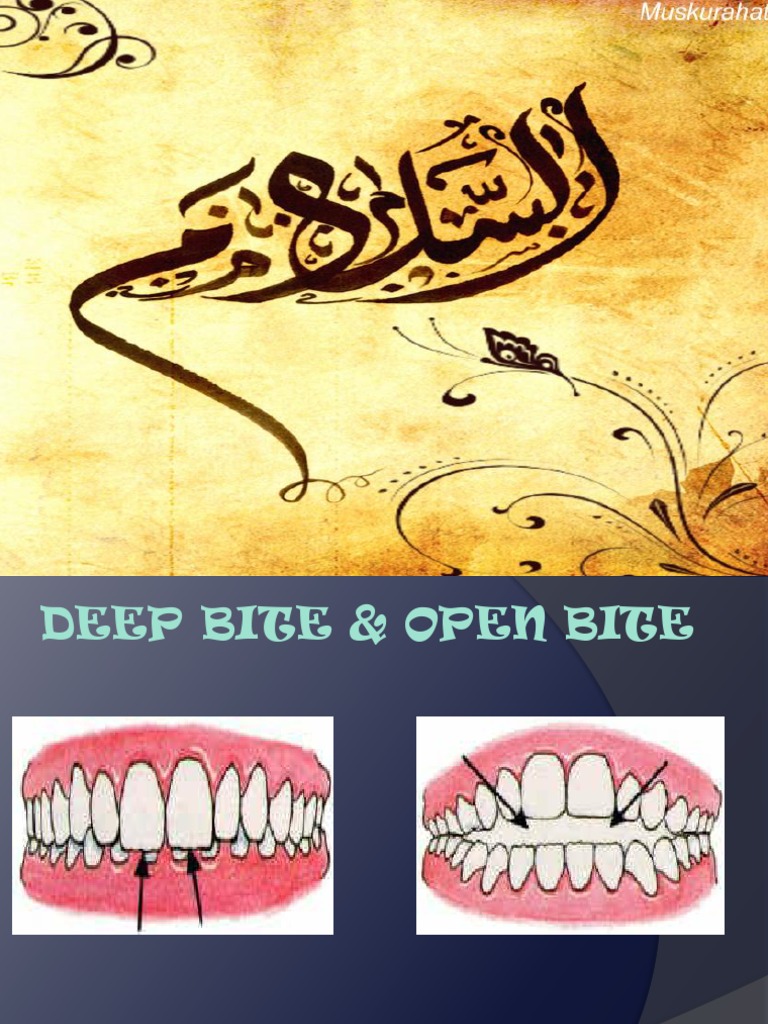Deepbite & Open Bite | PDF | Tooth | Animal Anatomy