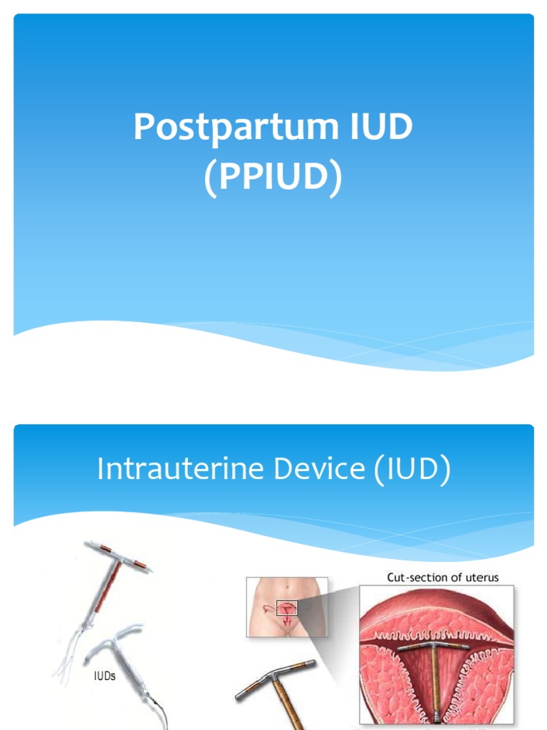 PPIUD | PDF | Hiv/Aids | Uterus