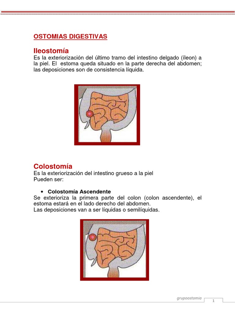 Tipos ostomias