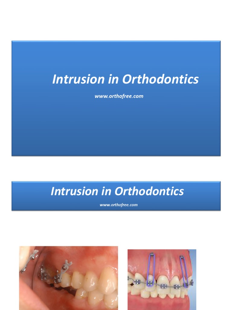 12-Intrusion in Orthodontics-Http://orthofree - Com/en | PDF ...