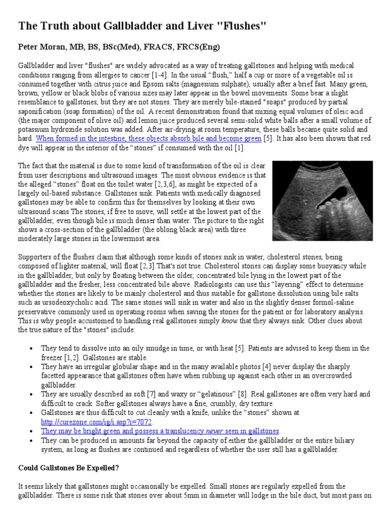 Debunking Gallbladder Flush Myths | PDF | Gallbladder | Bile