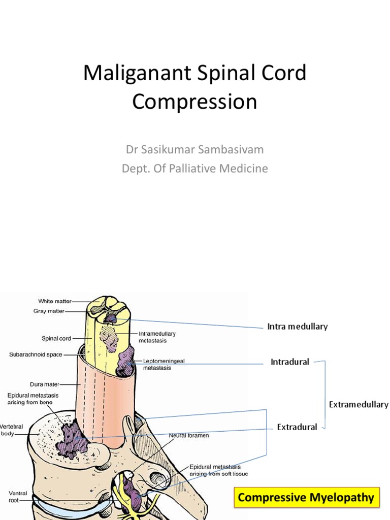 Malignant Spinal Cord Compression - Dealing The Most Common - Mets | PDF | Radiation Therapy ...